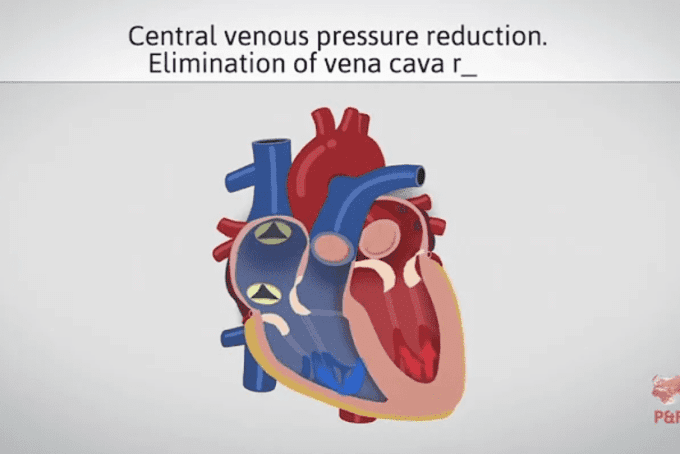 What is Pulsed Field Ablation (PFA)? Are there any side effects ...